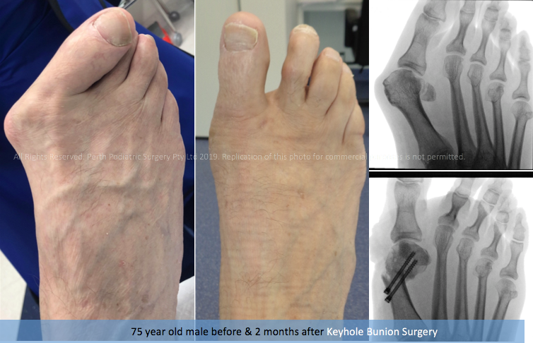 Foot Surgery Perth - Podiatric Surgery Perth | Perth Podiatric Surgery Foot Surgery Perth - Podiatric Surgery Perth | Perth Podiatric Surgery